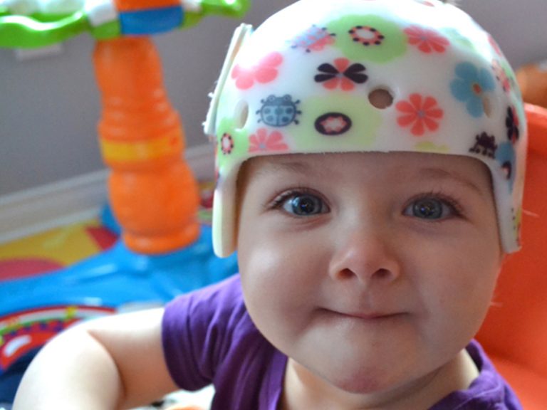 Órtesis craneal a medida - Ortopedia Neoforma